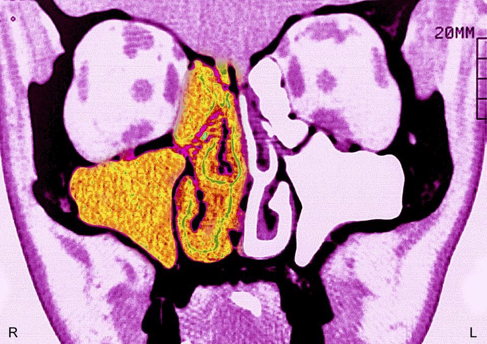 A Unique Nasal Spray Design Aims To Give Relief To Sinus Sufferers