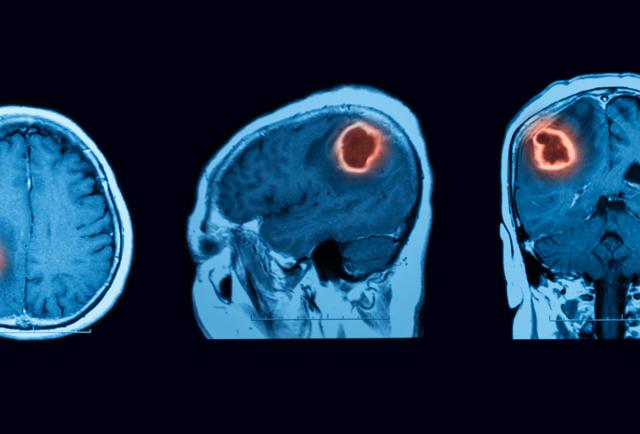 In Cancer Fight, Artificial Intelligence Is A Smart Move For Everyone