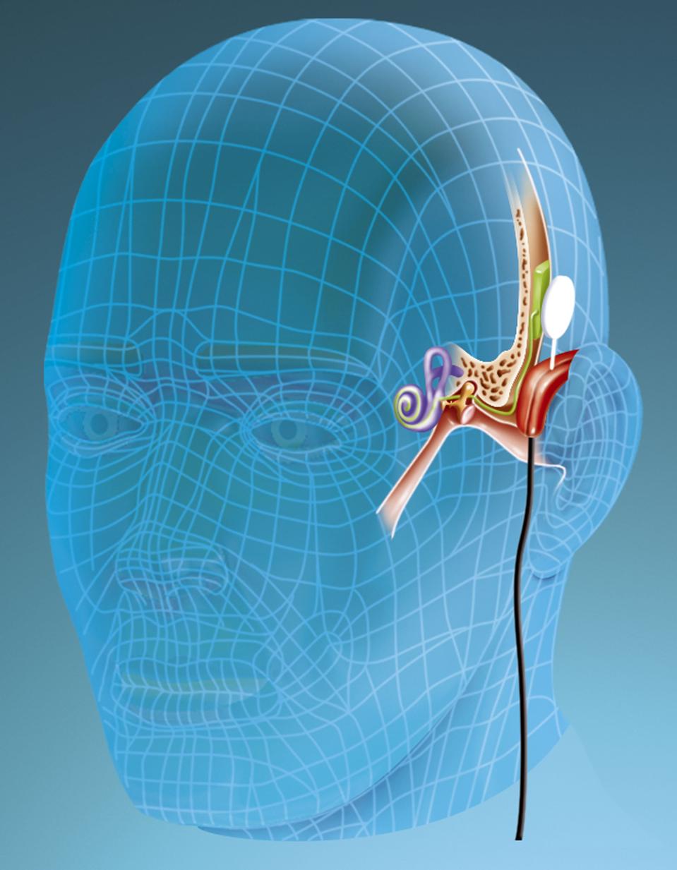 Consensus Study Says Cochlear Implants Can Help People With Severe ...