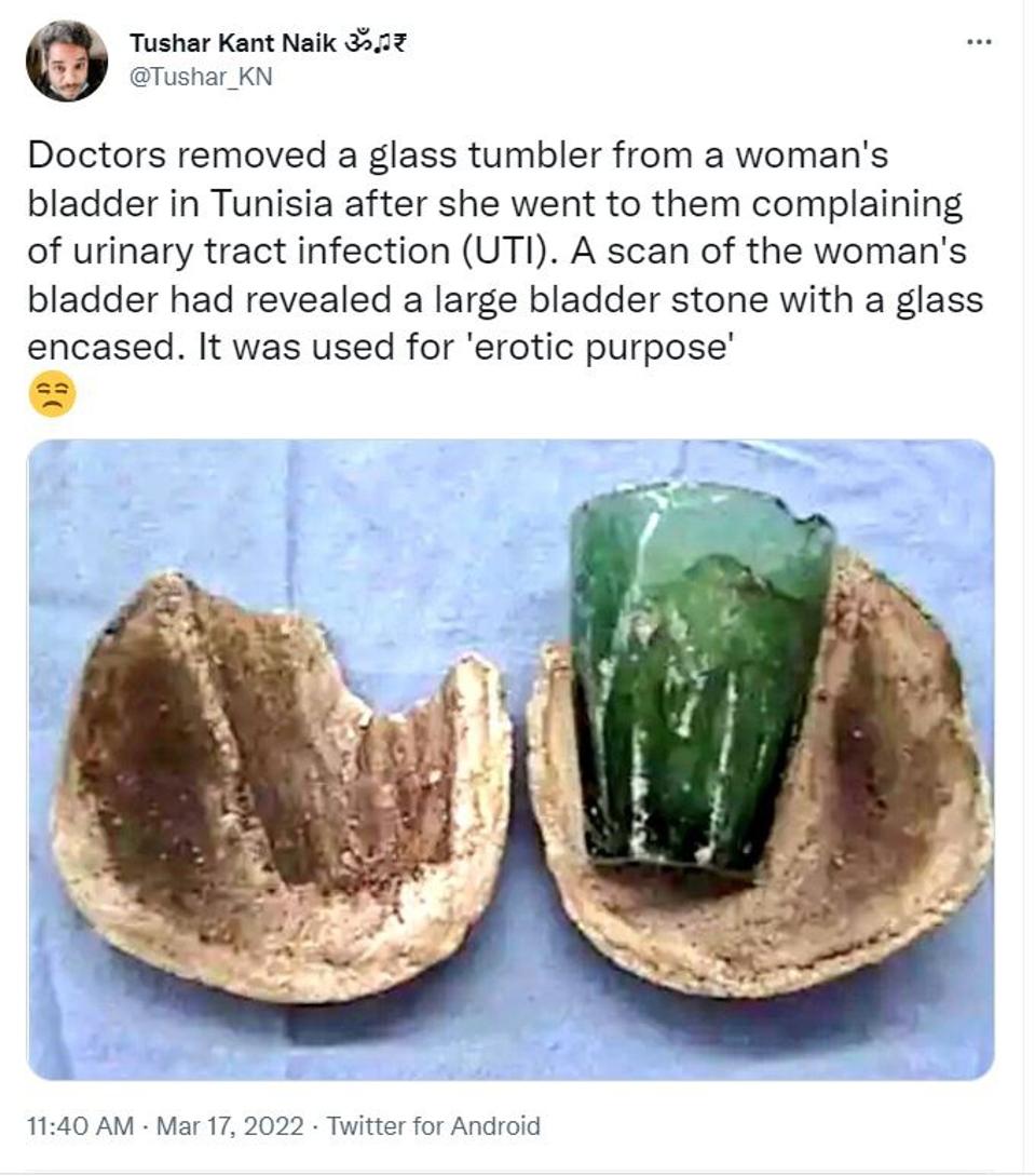 Glass Tumbler Found In Woman’s Urinary Bladder 4 Years…