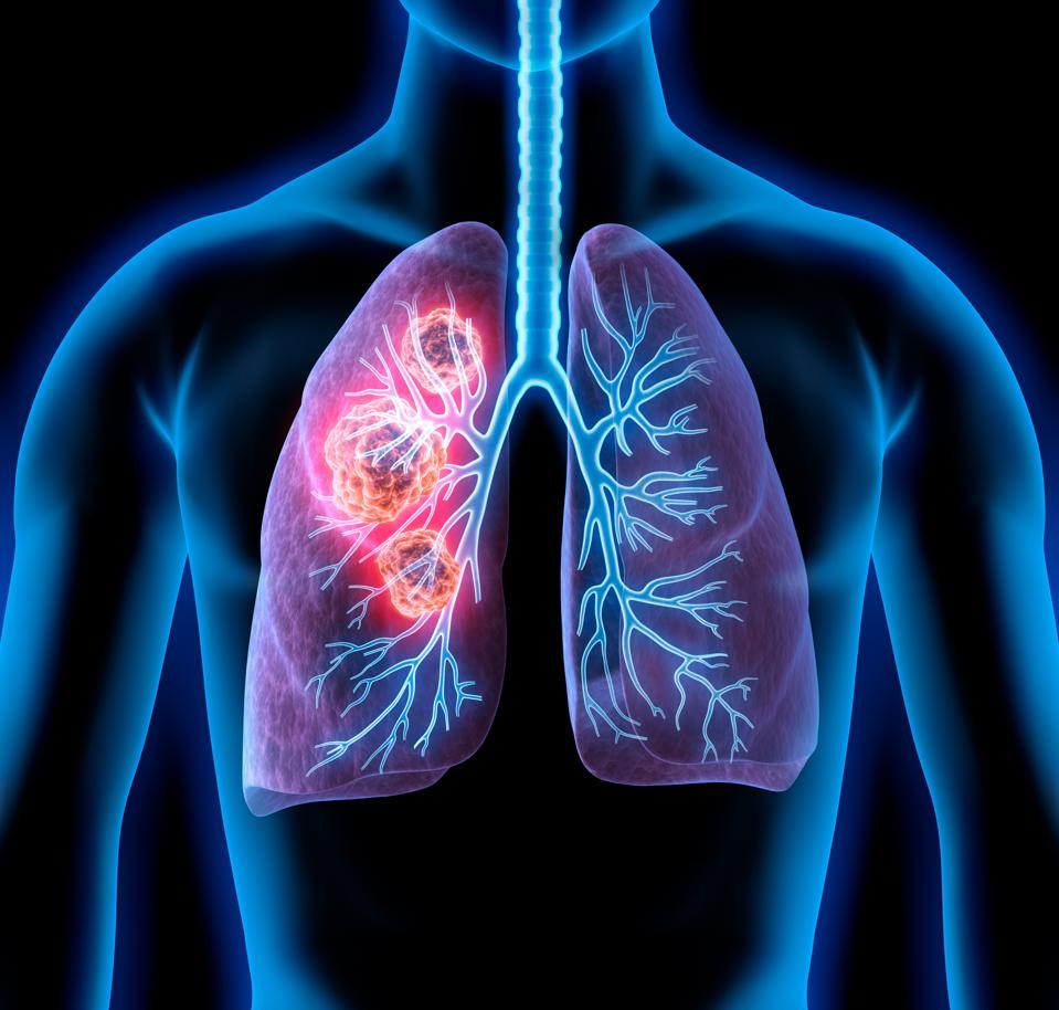 FDA Approves Drug Which Makes Lung Cancer Glow