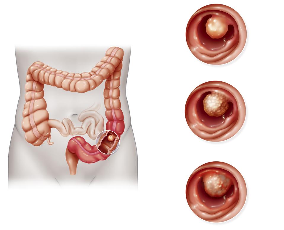 March Is Colorectal Cancer Awareness Month- Here’s What You Should Know