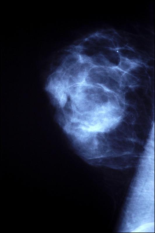 What You Need To Know About Male Breast Cancer