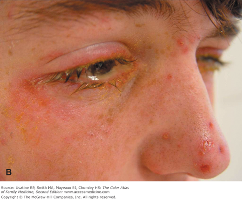 Understanding The Ocular Impact Of Steven-Johnson Syndrome