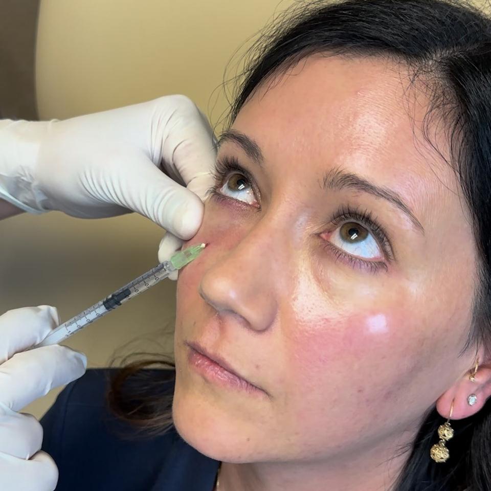 Dissolving Filler: Pros, Cons And Everything Else You Need To Know