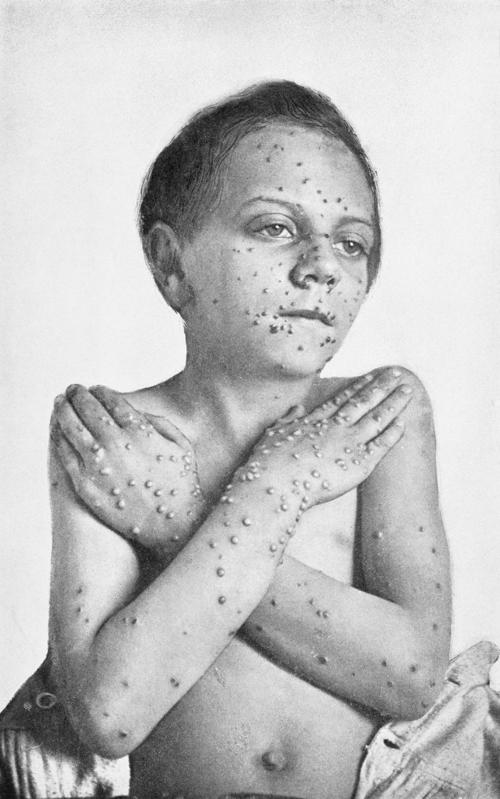 Will Destruction Of Smallpox Virus Get Postponed Again?