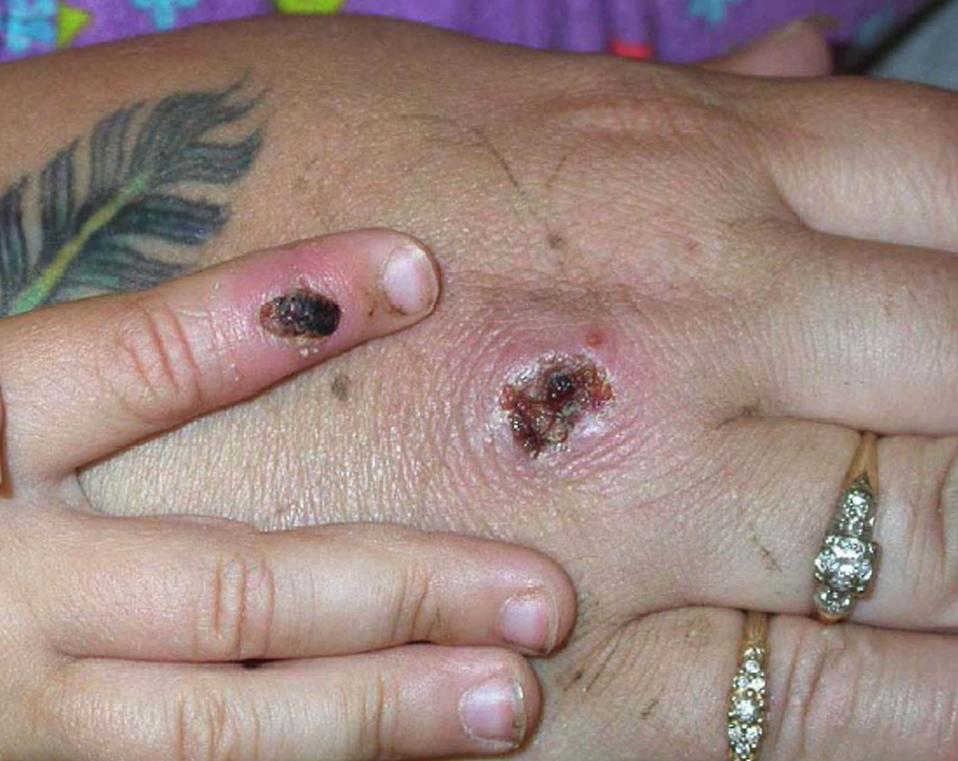 A New Strain Of Mpox Is Spreading In Congo. Here’s What To Know About ...
