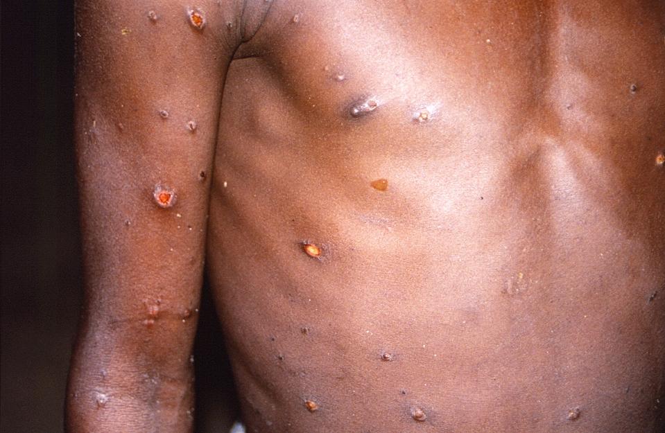 Mpox And Mask Bans—A Recipe For Disaster