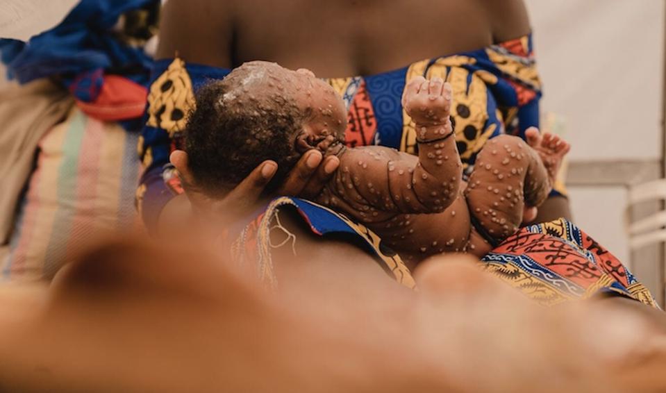 How UNICEF Fights Mpox In Democratic Republic Of The Congo