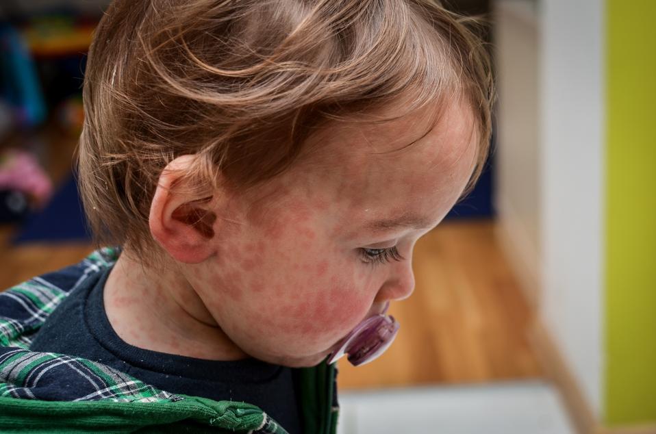 Health Experts Debunk Measles Misinformation