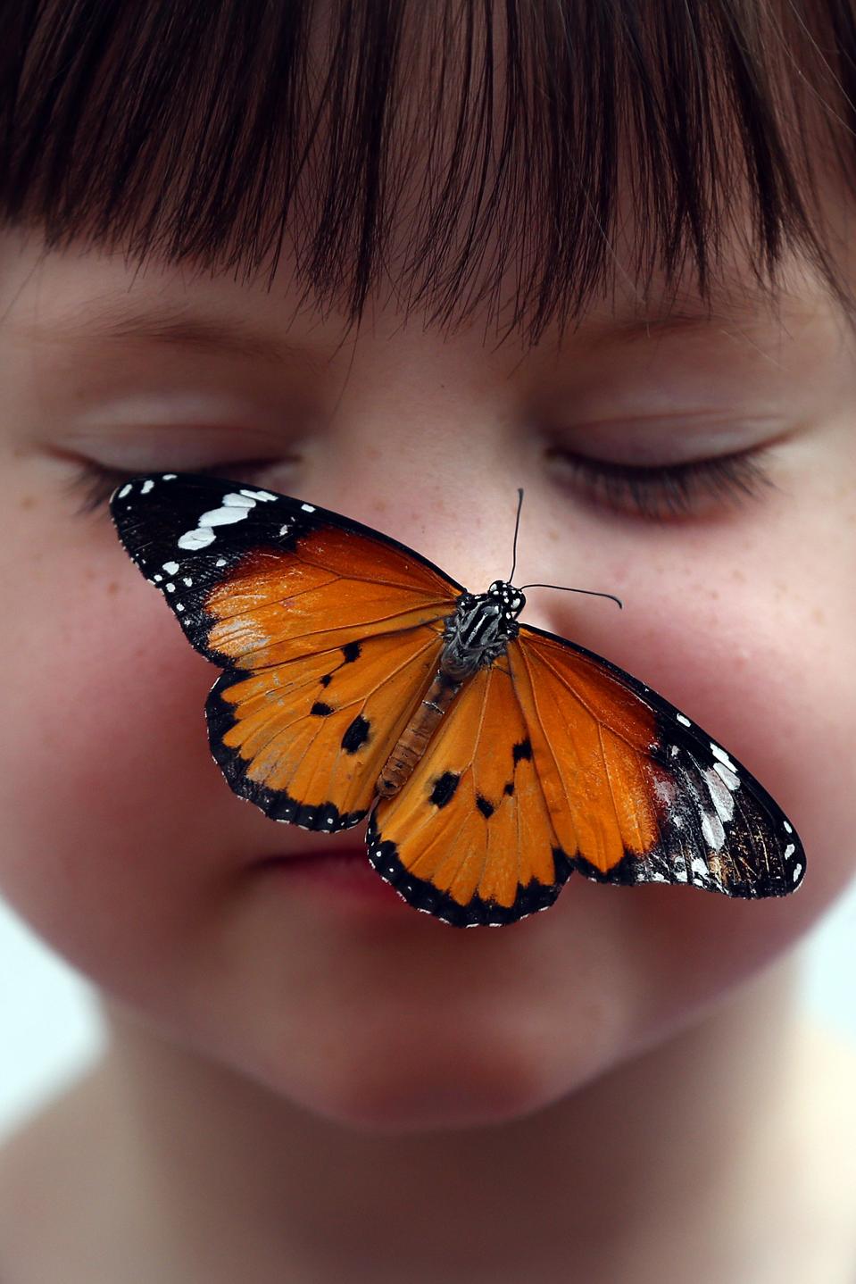 Breakthrough Gene Therapy For Butterfly Children’s Disease