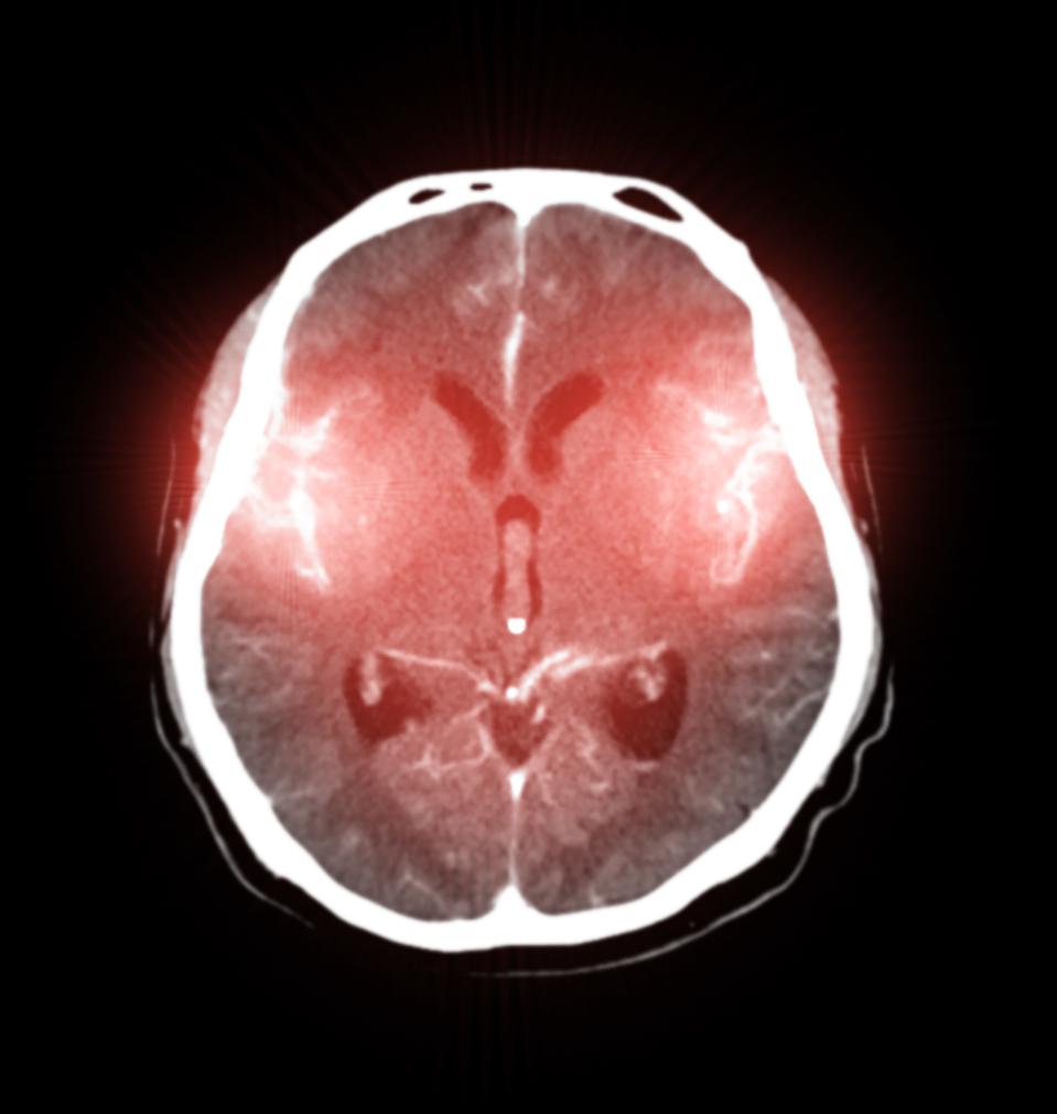 How Brain Bleeds Can Increase The Risk Of Dementia Decades Later