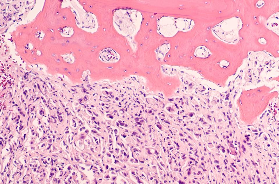 What Happens To Cancer Patients Who Aren't Treated?